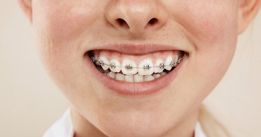 carrie braces